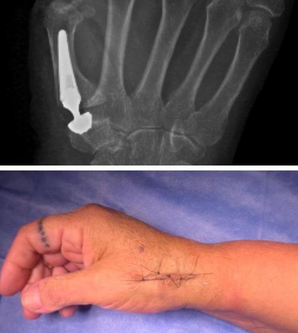 Innvadora cirugía de mano por primera vez en el interior del país